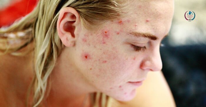 The Potential Benefits of Compounded Creams for Acne, Psoriasis, and ...